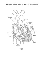 Collapsible and Expandable Prosthetic Heart Valves: Latest Innovations